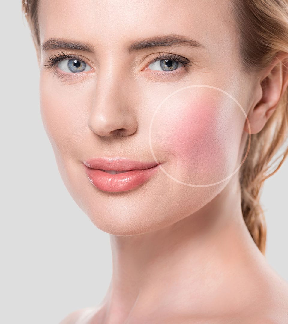 Rosacea Face | Rosacea on Face | Facial Rosacea